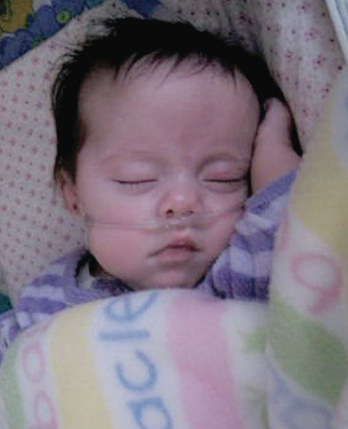 PRESSURE SAFE COMFORT SOFT PLUS NEONATAL (COLOR CODED WHITE) NASAL ...